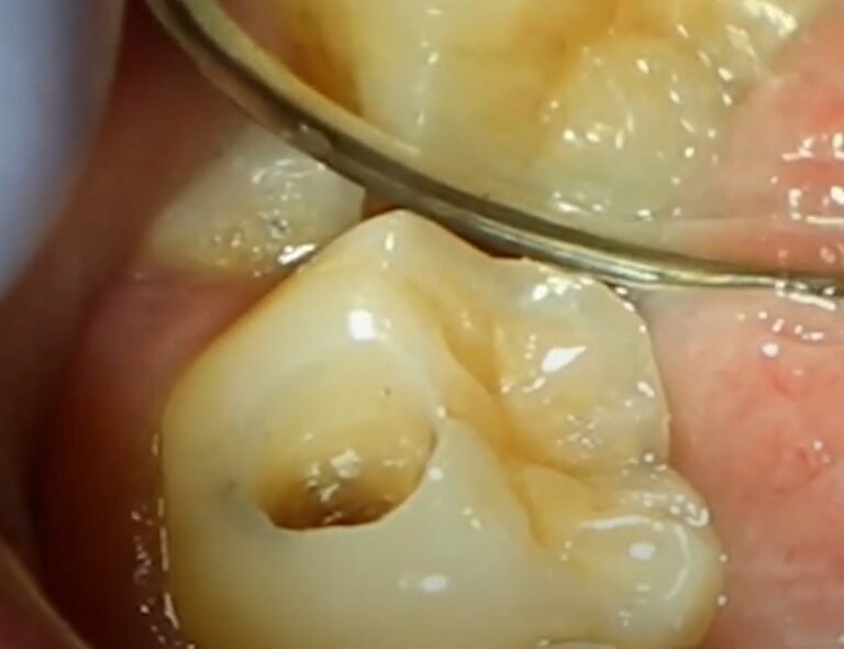 What Causes Tooth Cavity? - Tabib Asnan